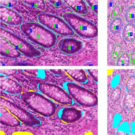 Colon Cancer Kaggle