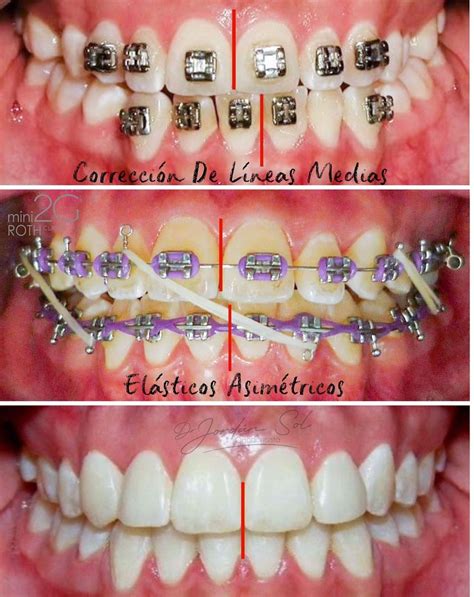 How To Put Rubber Bands On Braces Artofit