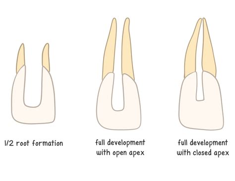 Pulpotomy Vs Pulpectomy My Dental Key