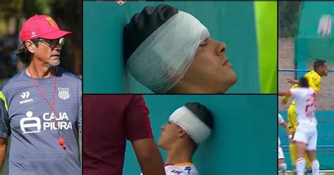 Futbolista De Atlético Grau Sufrió Triple Fractura Del Rostro Y Tiene