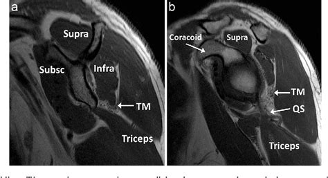 Figure 1 From Quadrilateral Space Syndrome A Review Semantic Scholar