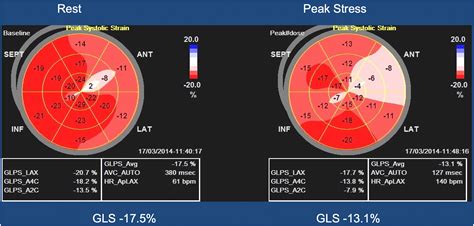 Assessment Of Postsystolic Shortening And Global Longitudinal Strain