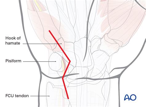 Hook Excision For Hamate Hook Fracture