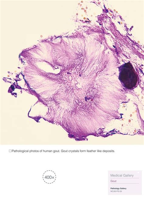 Urate Crystal Stock Image Image Of Cytoplasm Microscope 354577703