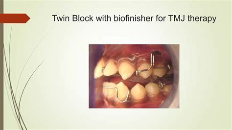 Twin Block Appliance Pptx