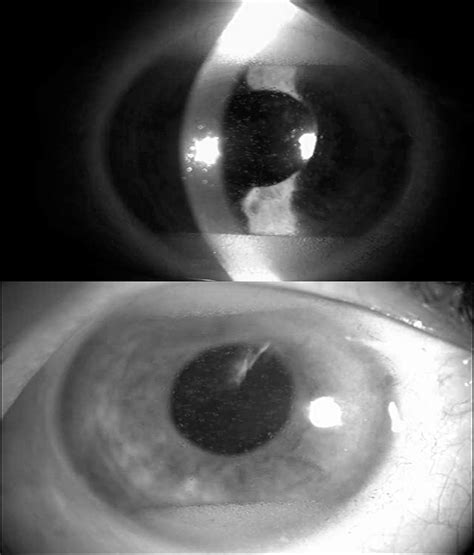Double Pseudohypopyon From Emulsified Heavy Silicone Oil Retinal Cases And Brief Reports