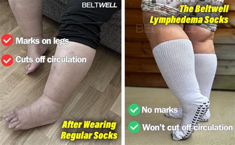 Beltwell The Oversized Lymphedema Socks That Wont Cut Off