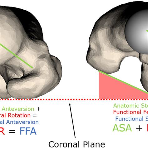 Left Illustration Of The Relationship Between Anatomic Femoral