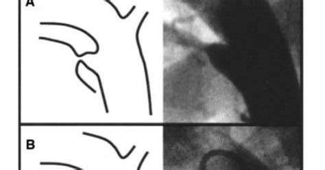 Pedi Cardiology Pda Morphologic Type By Angiography 1989