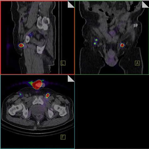 Preoperative SPECT CT Scan Of Sentinel Lymph Nodes Bilateral Evidence Download Scientific