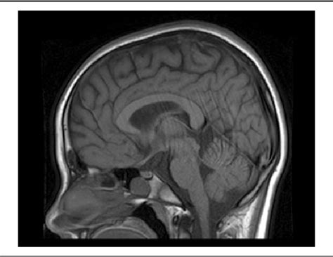 Sphenoid Sinus Polyp Semantic Scholar