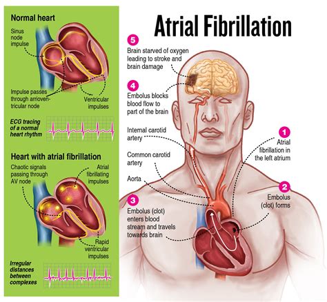 Ventricular Fibrillation Symptoms And Causes Artofit