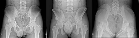 Osteochondroma Formation After Avulsion Fracture Of Anterior Inferior