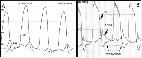 E Simultaneous Lv And Pcwp Pressure Trace Panel A From A Patient Of