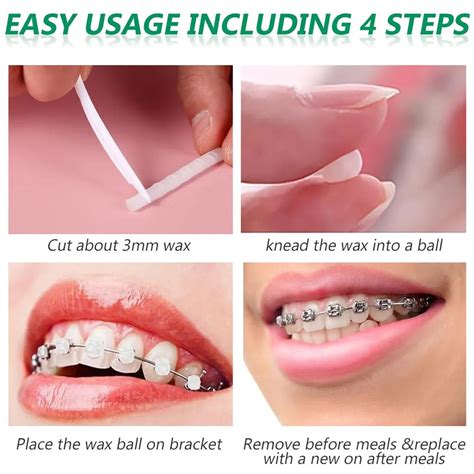 Buy U Ortho Orthodontic Relief Wax Pack Of 10 Oralkart