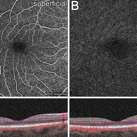 Clinical Features Of Different Types Of Namd A B Occult Cnv Type 1 Download Scientific
