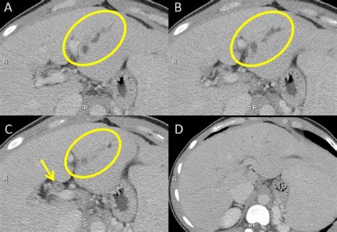Appearance Of Psc On Ct A C There Is Irregular Dilatation Of The Download Scientific Diagram
