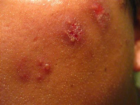 Everything You Need To Know About Shingles And How To Avoid It