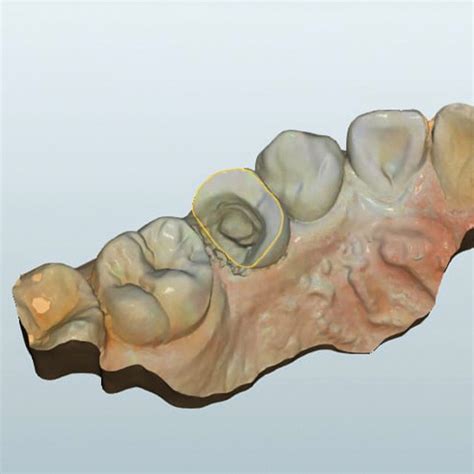 Cad Cam Fabricated Endodontic Crown Made From The Vita Enamic Multicolor Hybrid Ceramic
