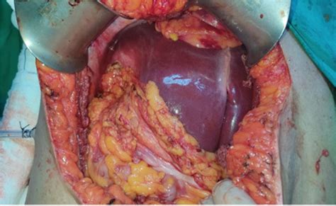 Is Omentectomy Necessary In The Treatment Of Benign Or Malignant