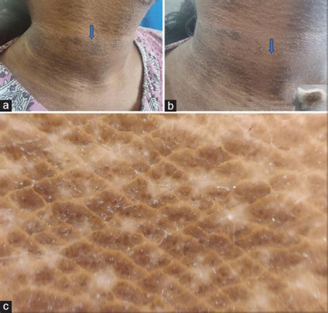 Dermoscopic Features Of Terra Firma Forme Dermatosis Tffd In Brown