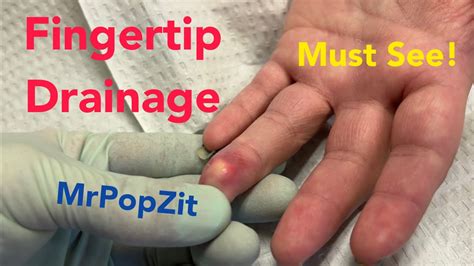 Finger Tophus At Georgia Kirsova Blog