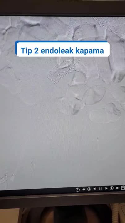 Ibrahim Yildizhan On Linkedin Tip 2 Endoleak Coil Embolizasyon