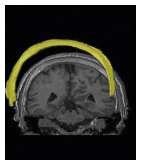 mri images under the three dimensional mark point positioning algorithm