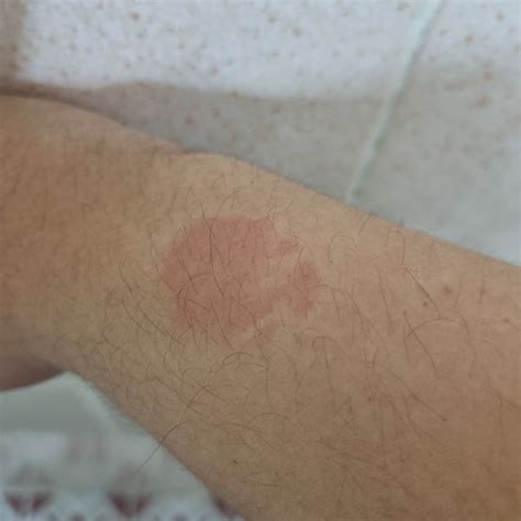 화상자국 봐주세요ㅠ 지식in