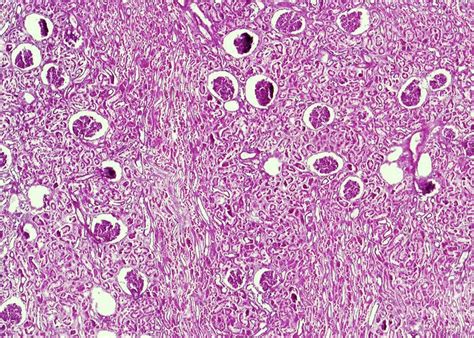 Diffuse Proliferative Glomerulonephritis 1 Greeting Card By Nigel