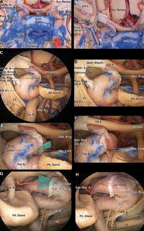 Cavernous Carotid And Carotid Cave Neuroanatomy The Neurosurgical Atlas