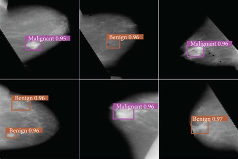 Results Of Breast Tumor Detection And Classification Using Improved Download Scientific Diagram