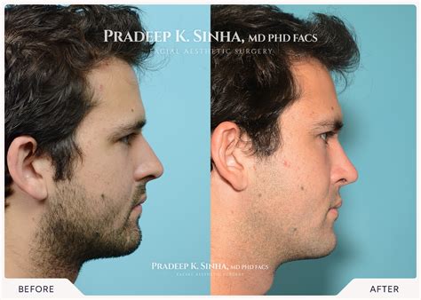 Before And After Photos Atlanta Facial Plastic Surgery Rhinoplasty