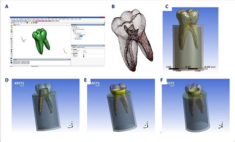 Figure 1 From Comparative Finite Element Analysis Of Endocrowns And Traditional Restorations For