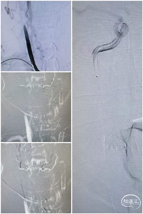 杨新光教授：局麻下同期处理双侧颈动脉多处狭窄 脑医汇