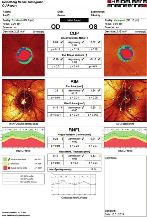 1 After Manually Delineating The Optic Disc Margin By Placing A Contour Download Scientific