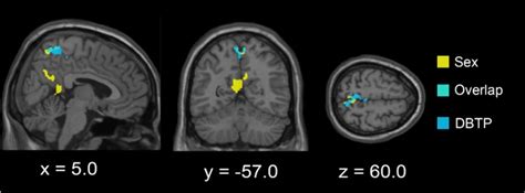 The Overlapped Region The Bilateral Precuneus Where Grey Matter