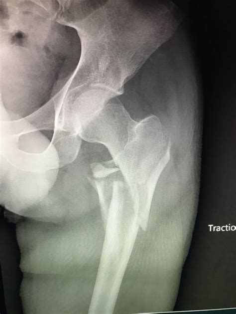 Broken Femur R Brokenbones