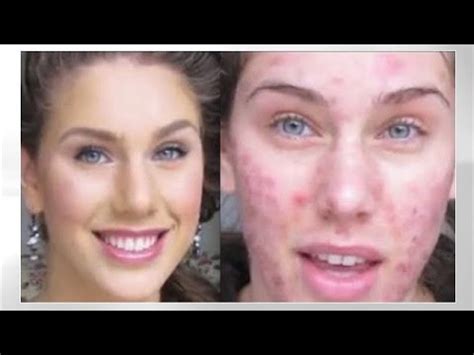 Acne Foundation Routine Pimples Scars Cystic Acne Blackheads And Oil