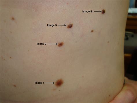 Dermoscopy Made Simple Clark Or Dysplastic Nevi