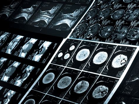 3d Printed Scaffolds Show Promise In The Healing Of Cranial Defects Regmednet