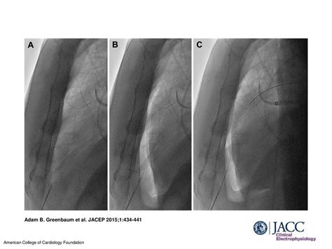 Adam B Greenbaum Et Al Jacep 2015 1 Ppt Download