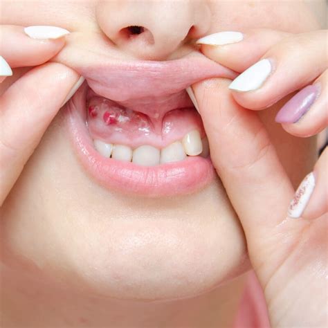 Pyorrhea Treatment Sood Dental Care Jalandhar