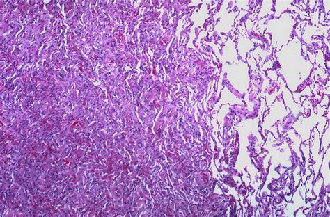 Atelectasis Collapsed Lung Tissue To The Left With Slit Li… Flickr