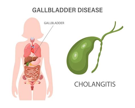 Premium Vector Gallbladder Diseases Infographic Banner Gallstone