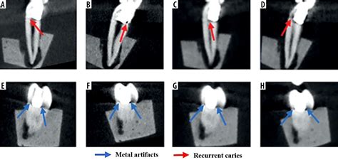 Performance Of Different Cone Beam Computed Tomography Scan Modes With And Without Metal