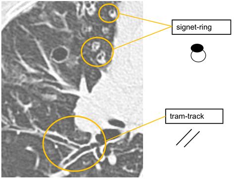 支氣管擴張 醫學影像學習園地 Signet Ring Signet Rings