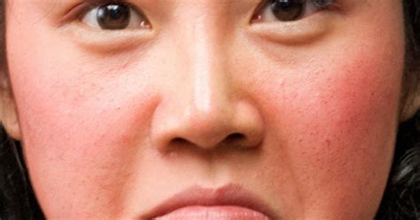 감정 변화로 생기는 안면홍조 “교감신경 절제술 효과적이다”