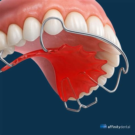 Hawley Retainers Philippines Adjustable Wire Retainers