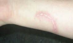 Bite Mark Tattoo
